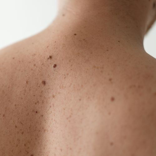 Dermoscopy for moles and other benign/malignant lesions - Dr. Hinah Altaf